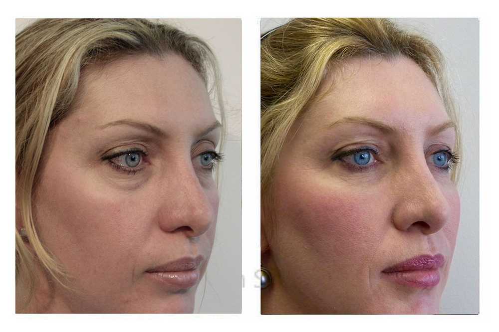 Dermal Fillers - Plastic Surgery Sydney