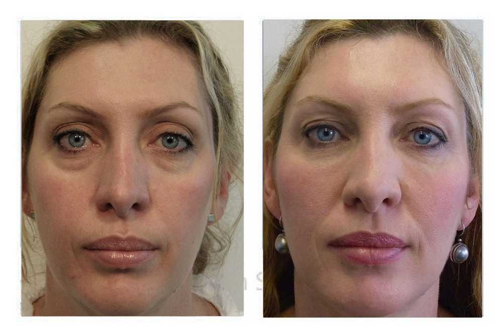 Dermal Fillers - Plastic Surgery Sydney