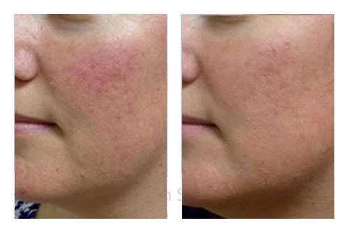 IPL & Laser Treatment - Plastic Surgery Sydney